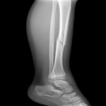 Blog - When your doctor says you have a fracture, do you know what they ...